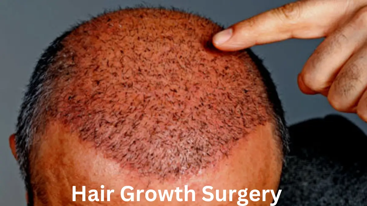 Hair Growth Surgery: A Complete Guide to Restoring Your Hair Naturally